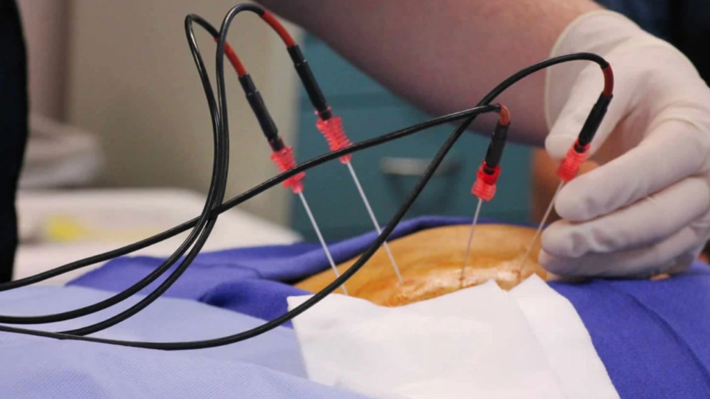 Radiofrequency Ablation: A Minimally Invasive Solution for Chronic Pain ...